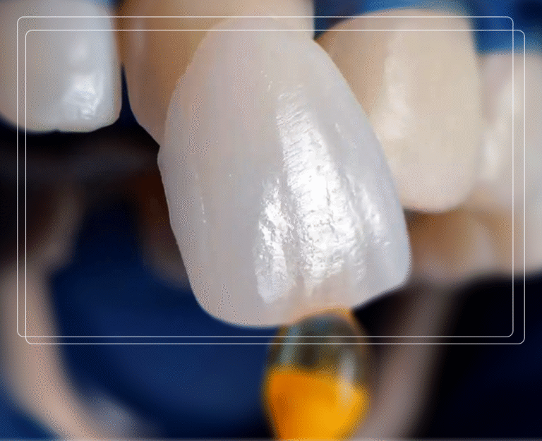 Laminate Veneers Istanbul Turkey | Uzmanlar Dental Clinic - Besiktas ...